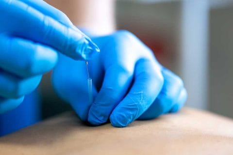 Dry Needling Vancouver (Intramuscular Stimulation Therapy) - North ...